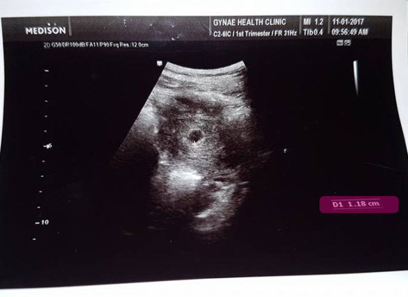 Slow Fetus Growth & Small Gestational Sac: End Of My Pregnancy